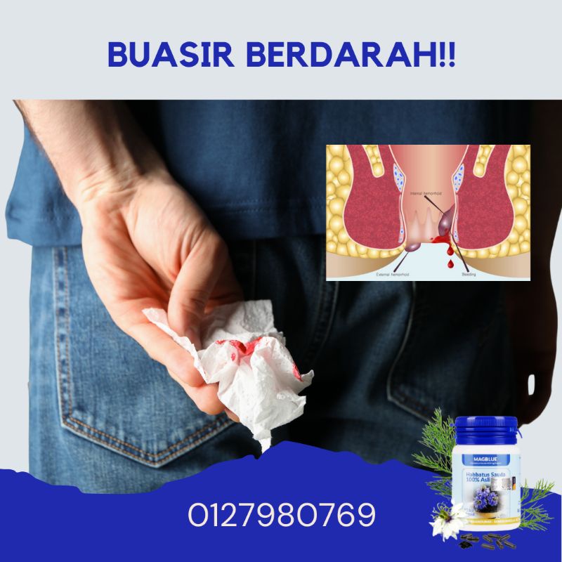 🩸 BUASIR BERDARAH !! 🎁 + Berak Luka Berdarah Hemorrhoids Mexblu ...