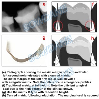 Dental Tofflemire Matrix for Deep Margin Elevation Dental Large ...