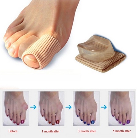 Orthopaedic surgery toe bursitis foot nursing foot therapy silicon pad ...