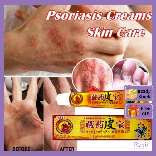 RUYII Eczema Treatment Anti Bacterial Skin Fungus Cream 原装藏药皮宝止痒膏 Ubat ...