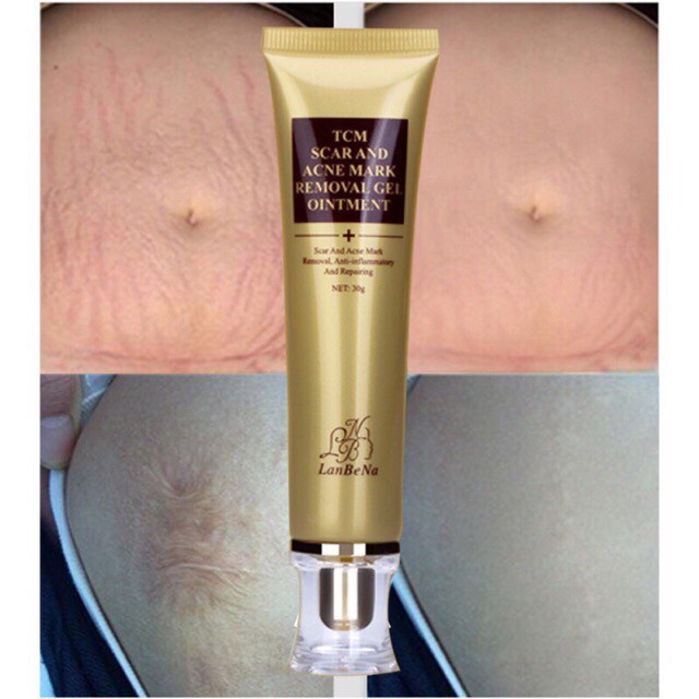 TCM SCAR AND ACNE Cream MARK REMOVAL GEL Repair Ointment/Hilangkan ...
