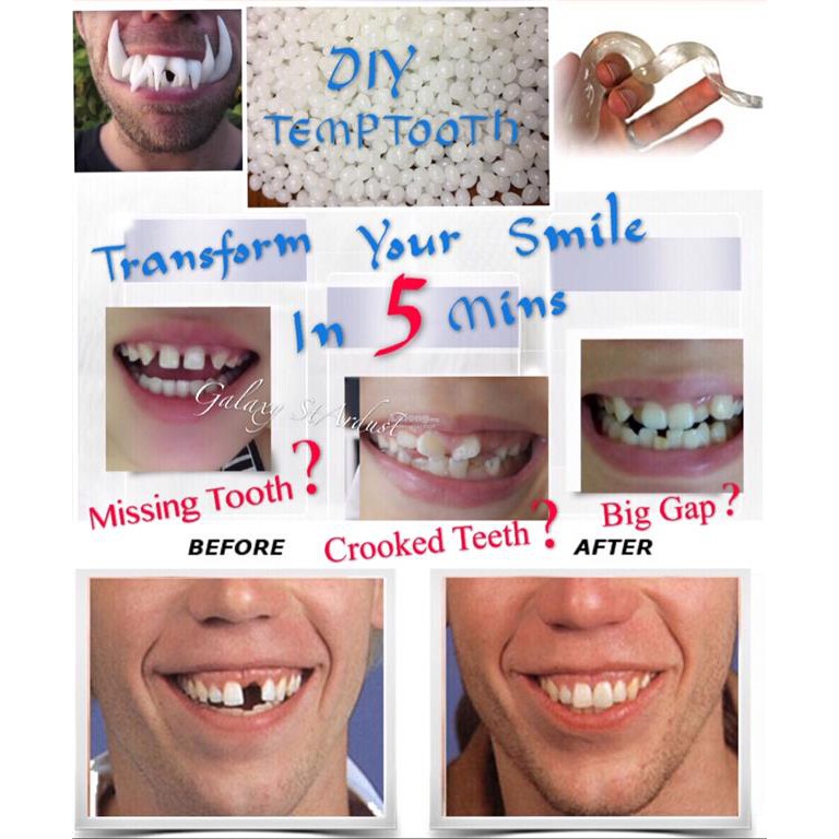 Temporary DIY Fake Tooth-Multi Purpose Thermo Moldable Polymorph ...