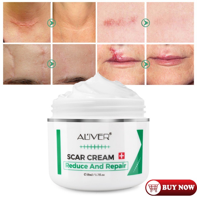 EEM EXO ALIVER Scar Removal Cream - Advanced Treatment For Face & Body ...