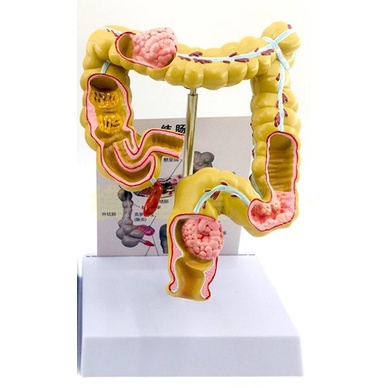 Human Colorectal Lesion Model / Intestine Model Pathological Anatomy ...