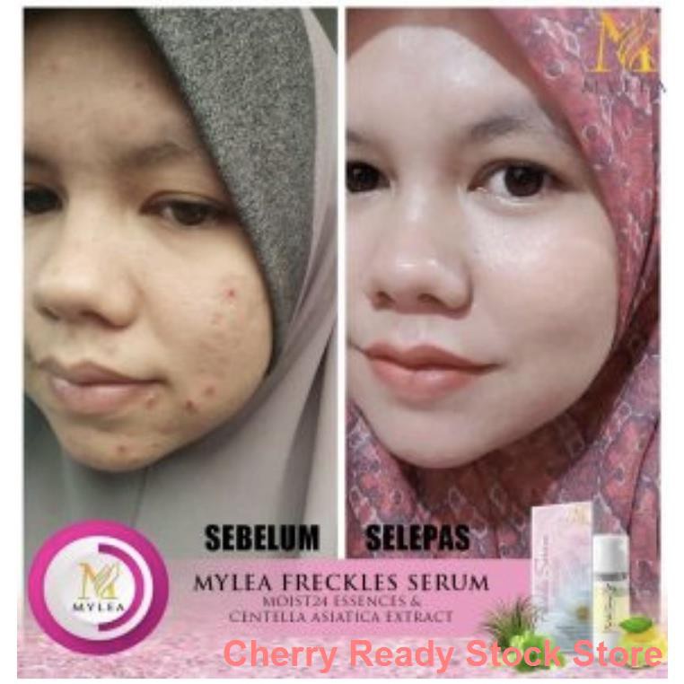 🔥 ORIGINAL 🔥 MYLEA FRECKLES SERUM & BAR 🔥 MYLEA SERUM 🔥 MYLEA BAR | Shopee Malaysia
