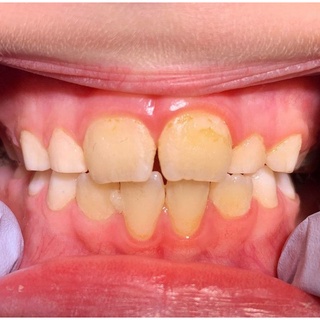 [Imported from Sweden]TePe PlaqSearch™Pemium Dental Plaque Disclosing ...