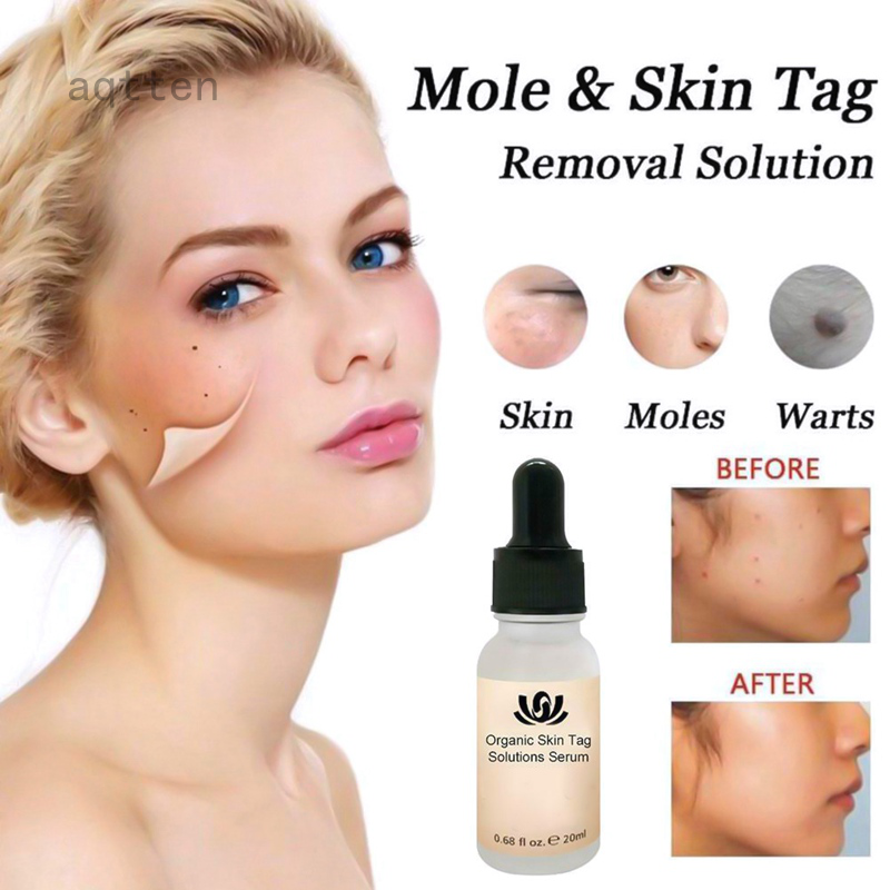 Mole removal syrup on the face to repair and remove moles and black ...