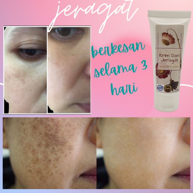 krim dani jeragat original/hilang bintik hitam/jerawat/jeragat | Shopee ...