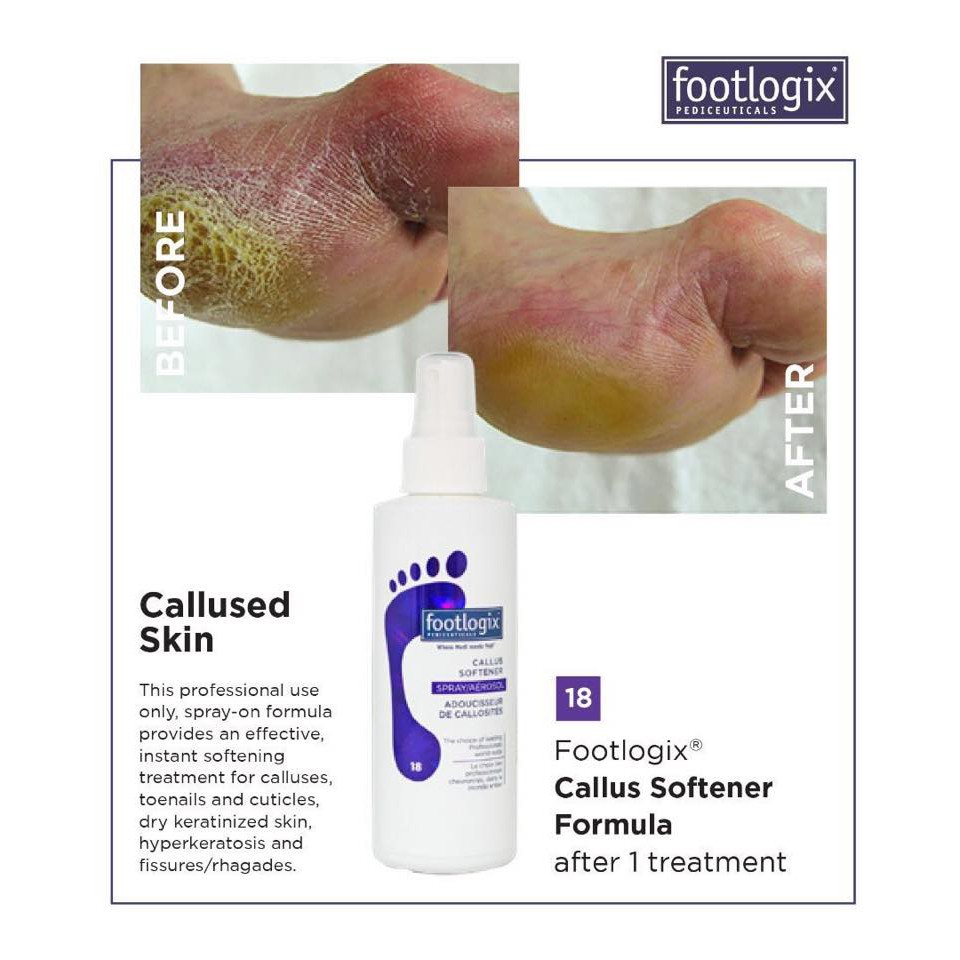 Footlogix Callus Softener Formula(180ml) | Shopee Malaysia