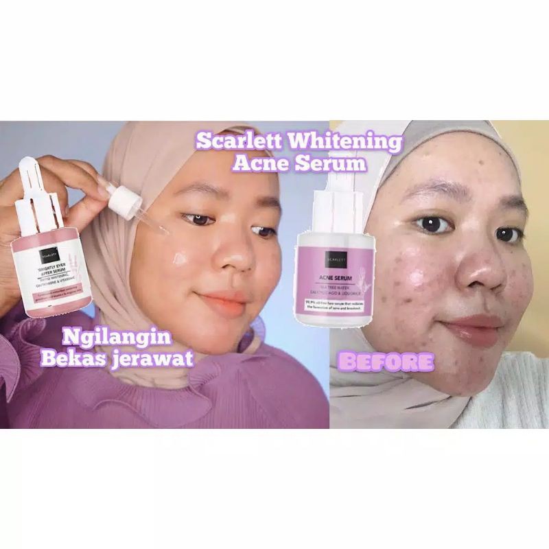 Acne SCARLET SERUM, BRIGHT & GLOWING | Shopee Malaysia