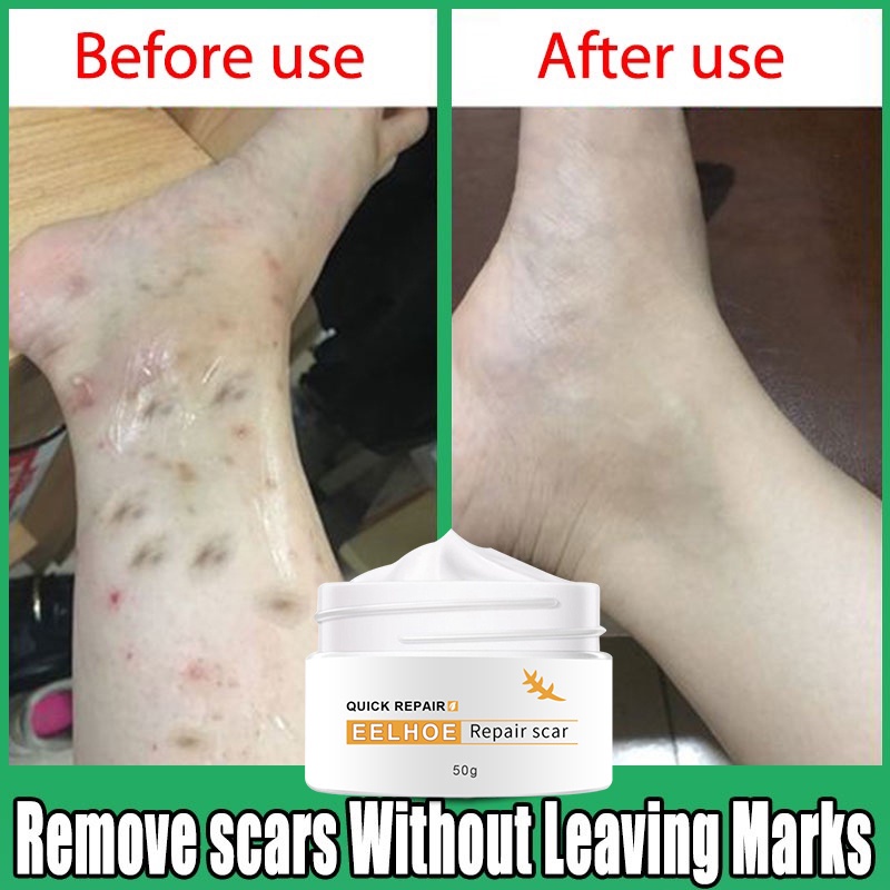 EELHOE Scar Removal Cream 50g - Say Goodbye to Old Scars, Acne, and ...