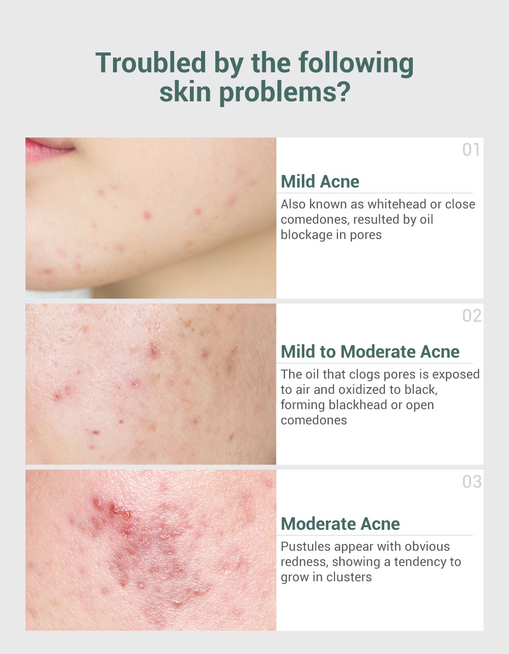 🔥Clearance🔥LANBENA acne control Cream - Acne Spot Prone Gel Remove ...