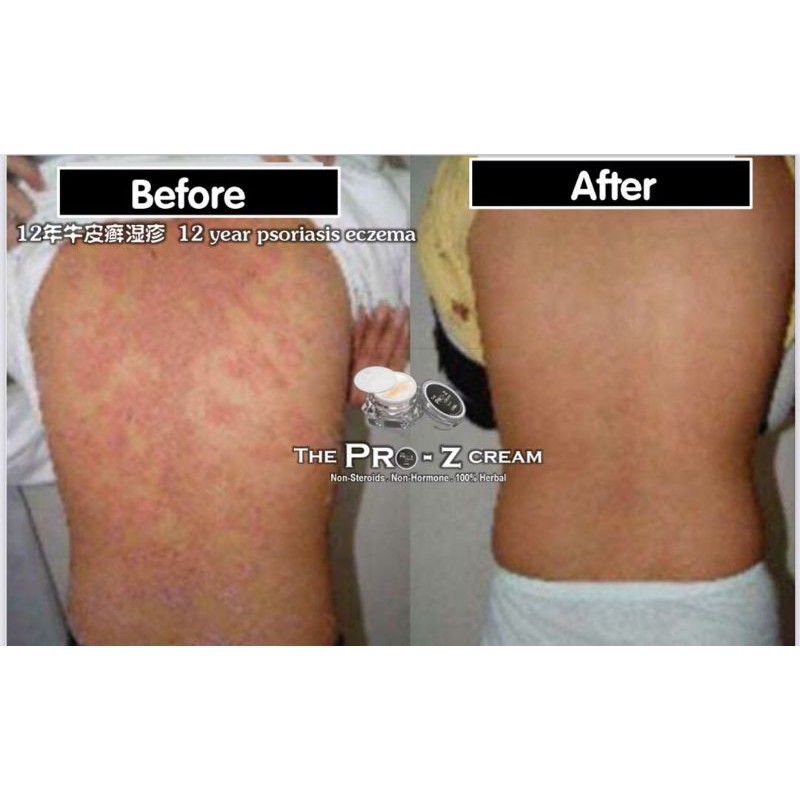 THE PROZ CREAM 300 GRAM -KRIM EKZEMA/ KURAP (99% HEALED ECZEMA ...