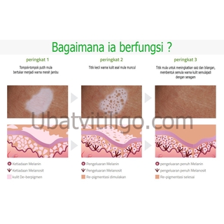 Penawar Penyakit Sakit Sopak/ Vitiligo- Vitiligo Organics Naturally ...