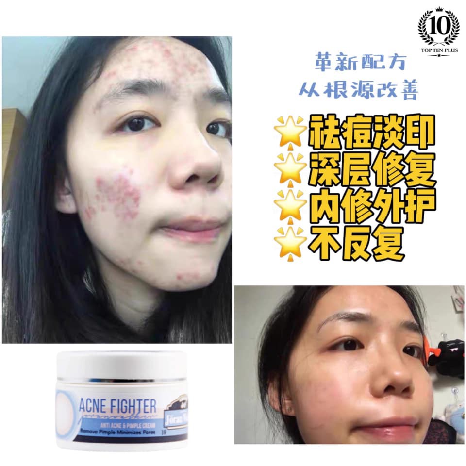 Joran Walker Acne pimple cream Fighter 痘痘膏【战痘神器】 | Shopee Malaysia
