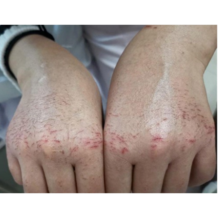 Herbal Topical to Prevent Cracking, Swelling, Dryness, Peeling, Peeling ...