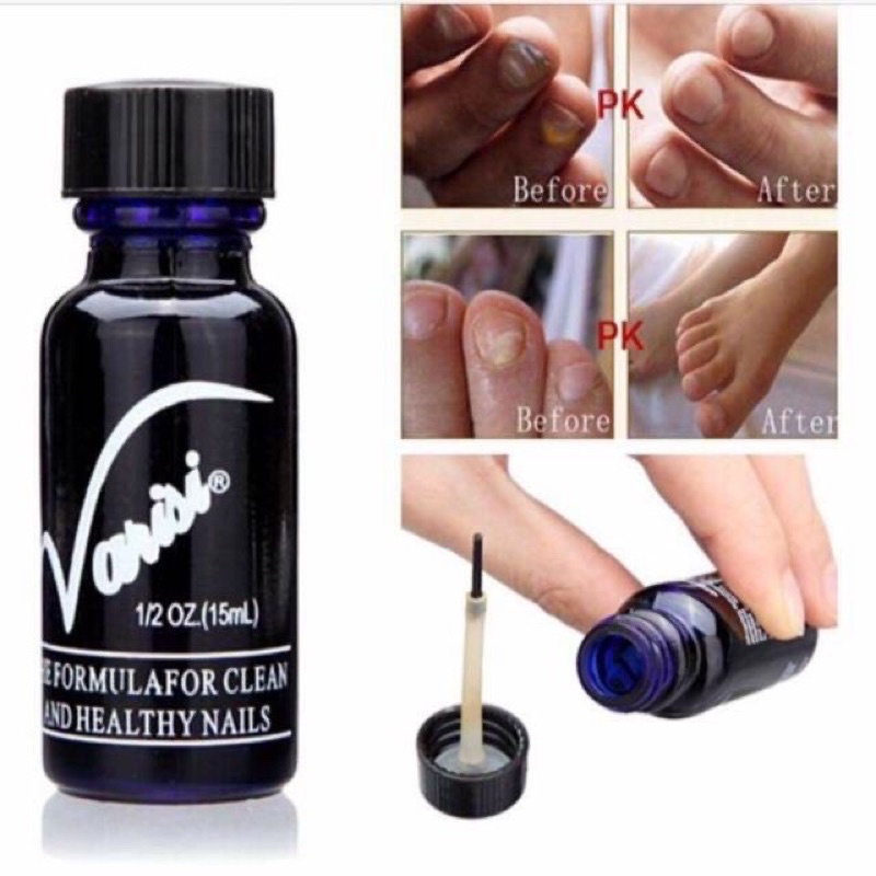 Varisi anti-fungal HandPiece, fungus FootPiece | Shopee Malaysia