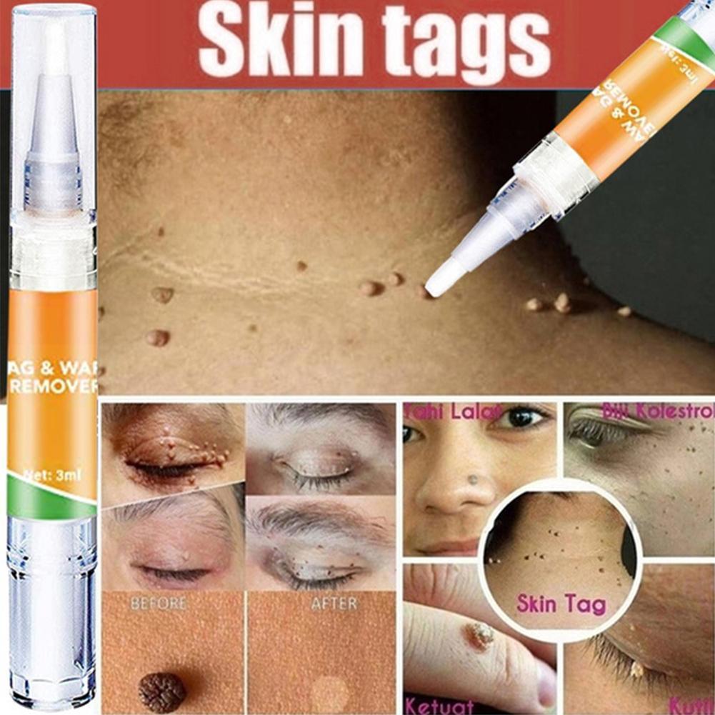 1Pcs Gram Wart Liquid Skin Beauty Removing Wart Pen 3Ml R5C6 | Shopee ...