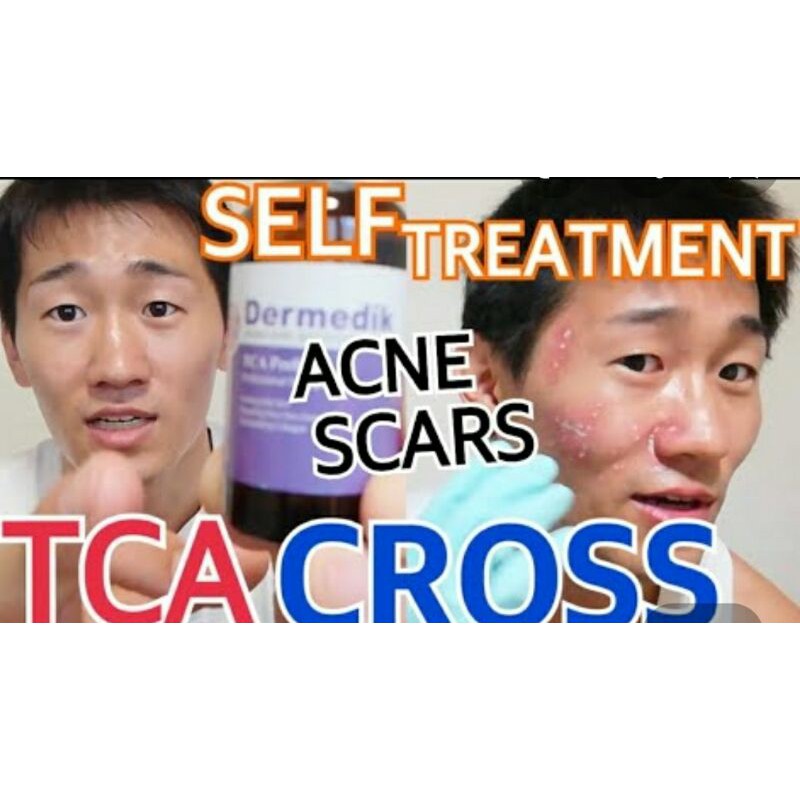 Tca 100% 10ml (muka berlubang,parut lekuk,atrophic acne scar) | Shopee ...