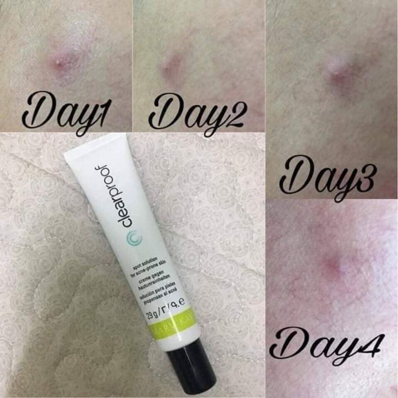 MK Clearproof Acne Treatment Set (Exp 2024) | Shopee Malaysia