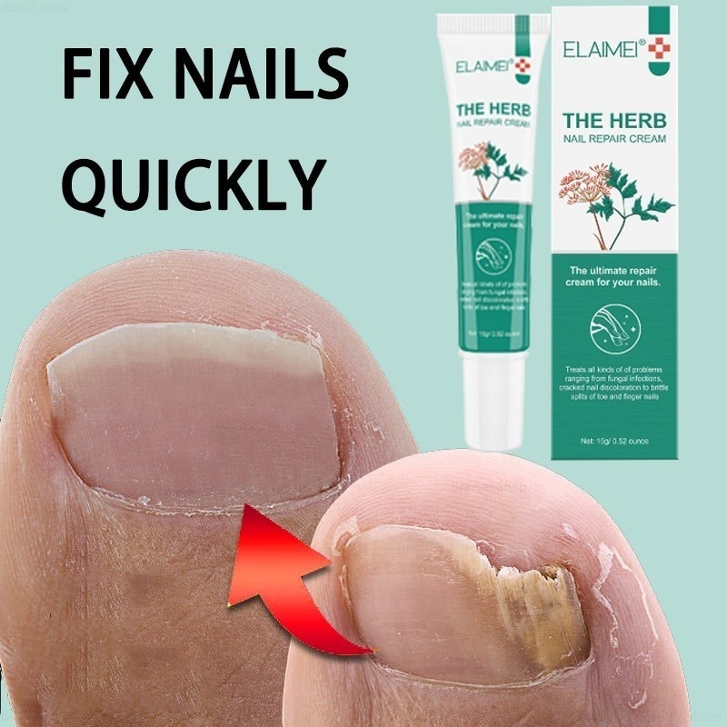 Fix Bad Nails Quickly Inhibit Nail Fungal Infection Remove Paronychia ...