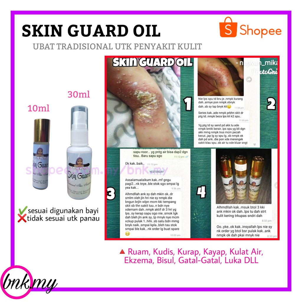 UBAT KURAP KAYAP RUAM KUDIS BISUL ECZEMA SENSITIVE SKIN OIL ITCHY AID ...