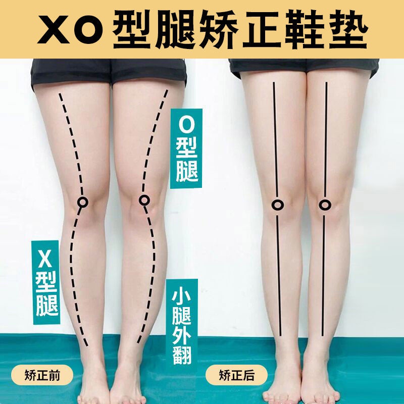 O-shaped leg correction insoles, leg-shaped straight leg arto型腿矫正鞋垫矫正腿型 ...