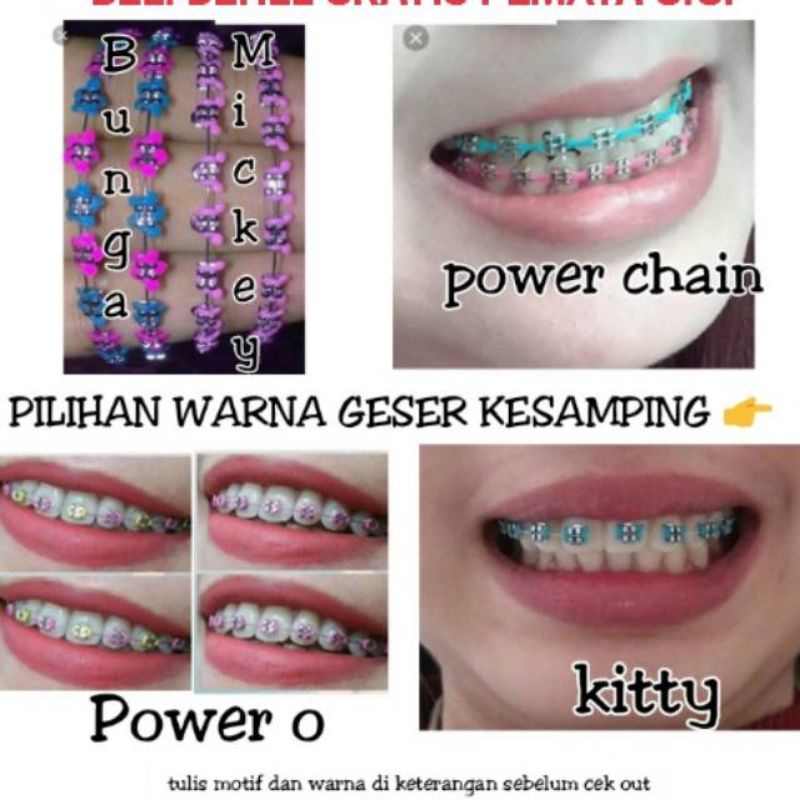 Removable Braces Removable Fashion Braces/ Upper and Lower Braces Only ...