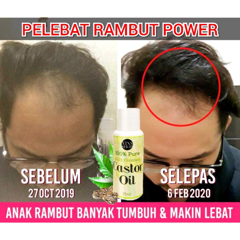 PELEBAT RAMBUT MINYAK BUAH CASTOR / CASTOR OIL HAIR GROWTH THICK ...