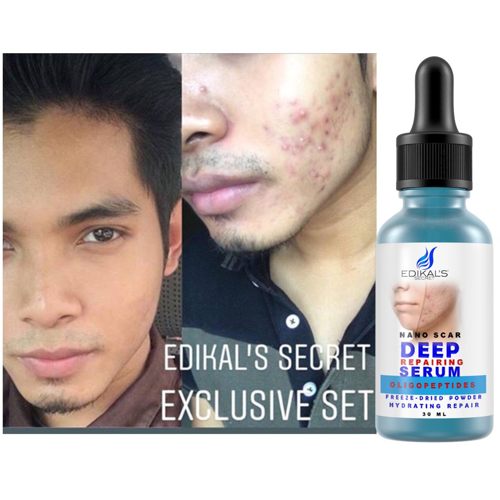 maybelline Edikal's Secret Clear Acne Enzyme Soap,Elixir Scar Serum,Set ...