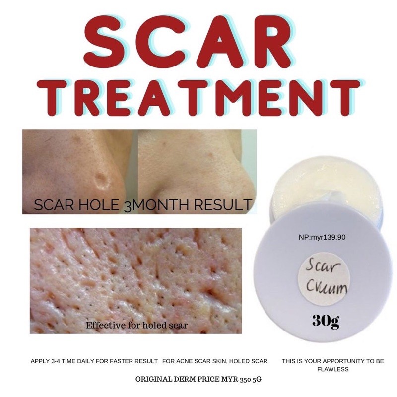 KRIM PARUT LEKUK Klinik Kulit Original LUBANG SCAR Berlubang Parut ...