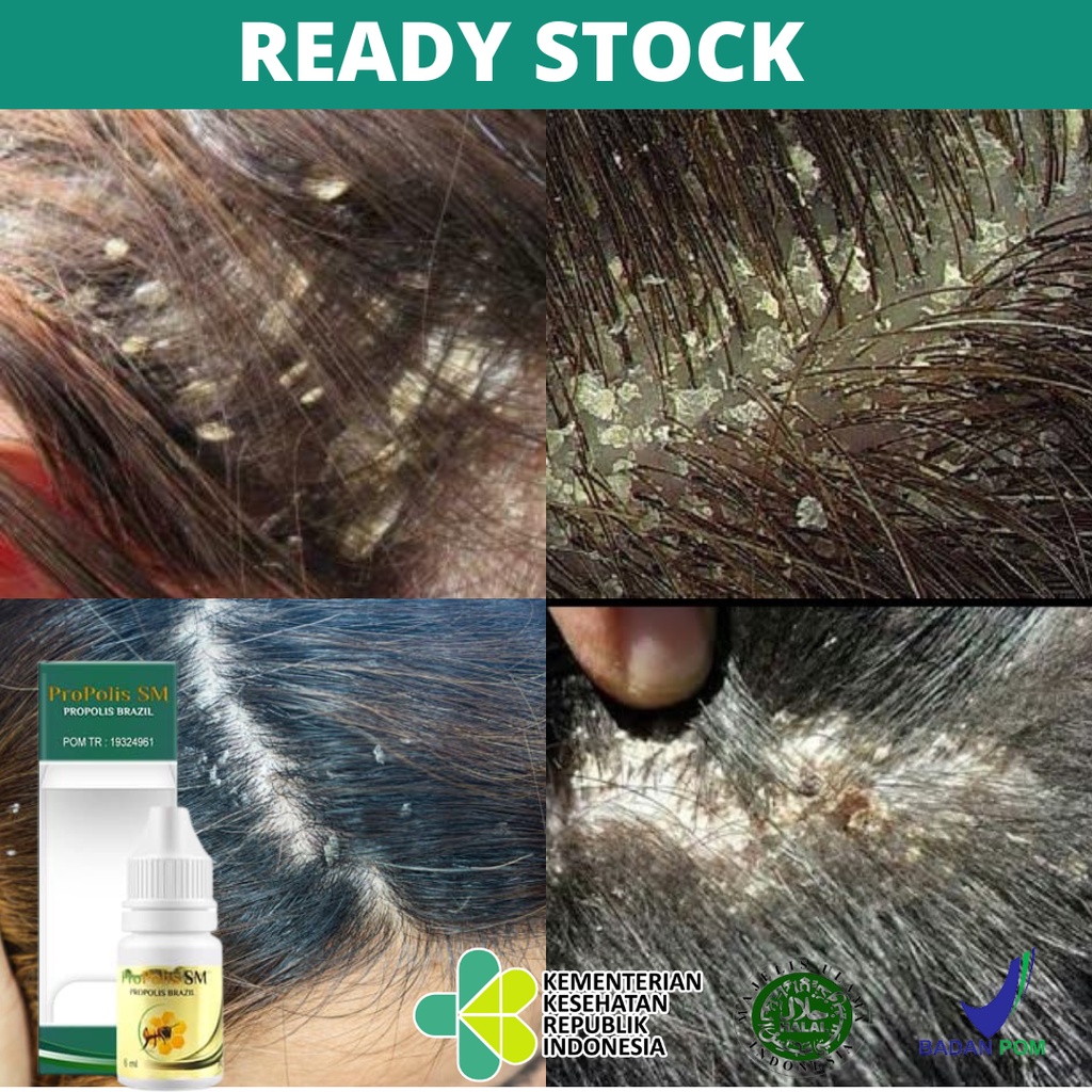 Scalp Dandruff Drops, Scalp Dandruff Medicine, Scalp Fungus, Severe ...