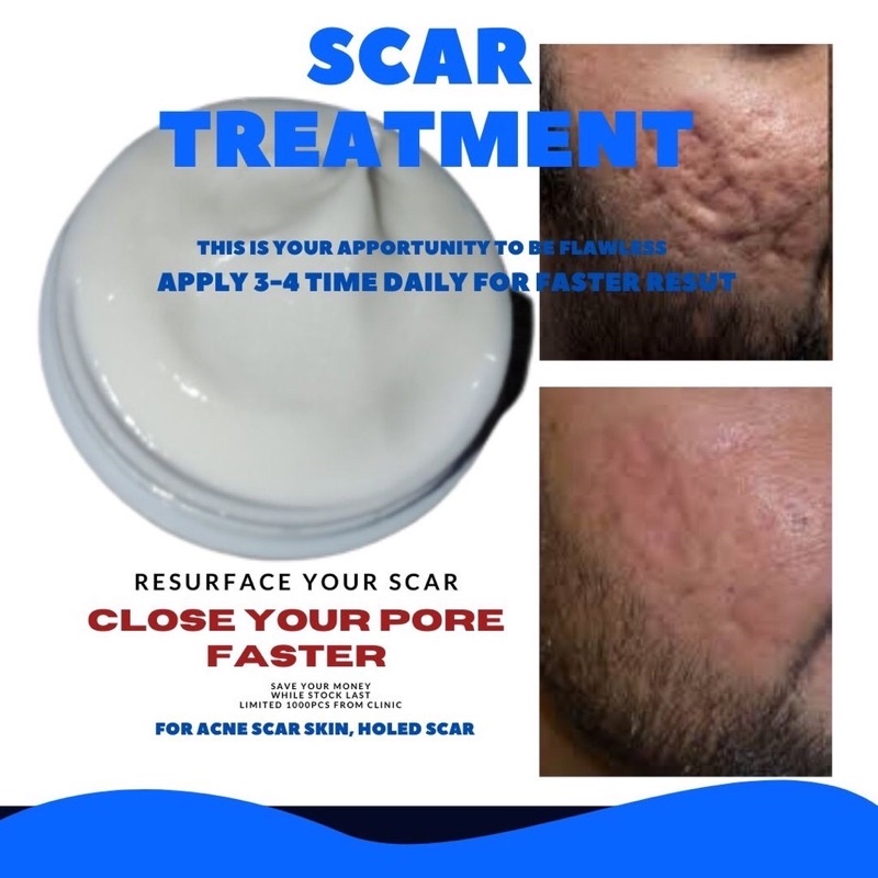 Krim Scar Parut Hitam Parut Lubang/Lekuk Klinik Kulit | Shopee Malaysia