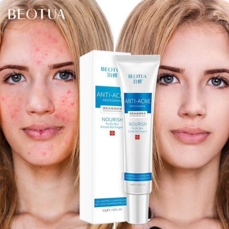 BEOTUA 🔥 acne cream whitening skin care anti acne treatment cream oil ...