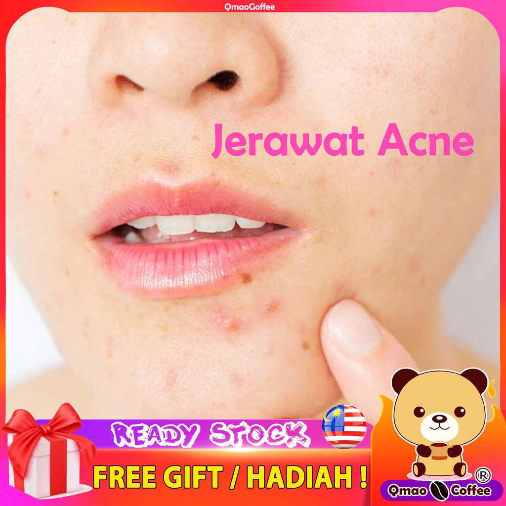 Krim Jerawat Acne Cream Pimples Cream 10g | Shopee Malaysia