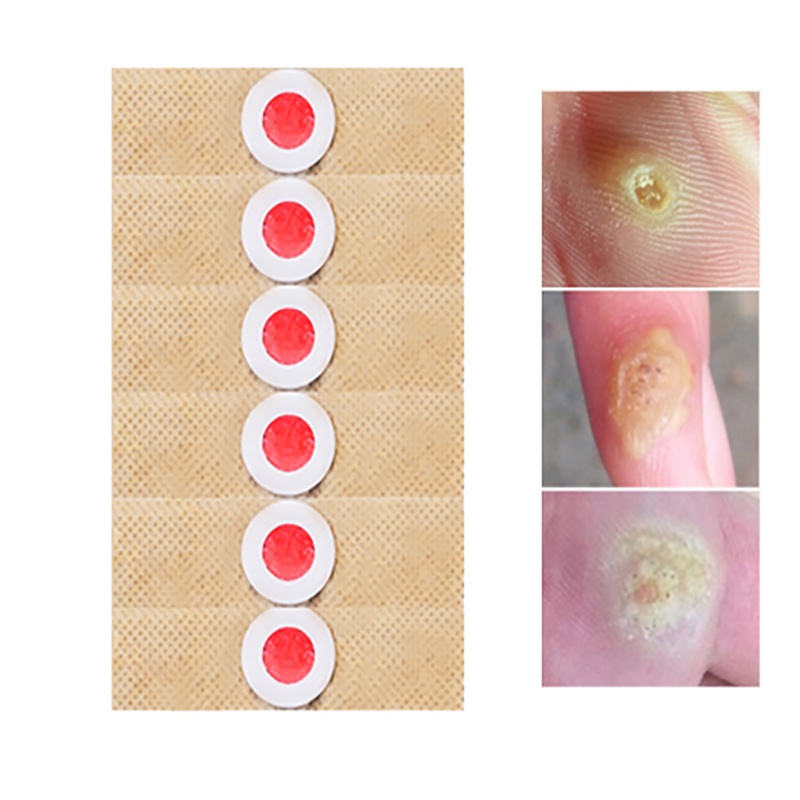 20Pcs/lot Foot Care Sticker Medical Patch Corn Removal Pads Warts Thorn ...