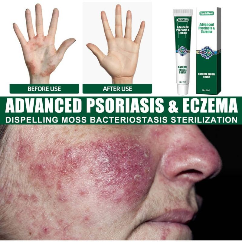 Psoriasis Ezcema Anti Itchy Cream 20g/ Obat Gatal/ Anti Mites Fungus ...