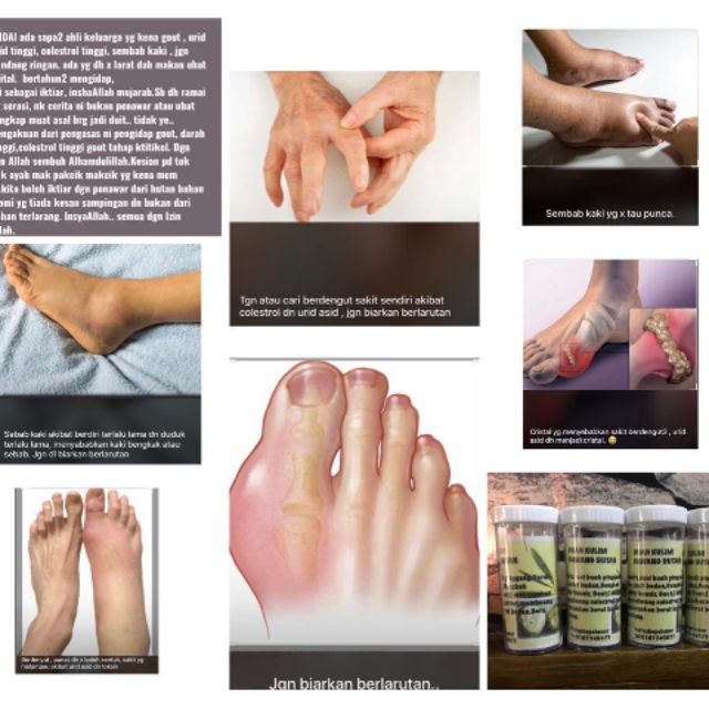 🔥🔥Ubat gout🔥🔥 ubat tradisional ramuan turun temurun💯%% ramuan semula ...
