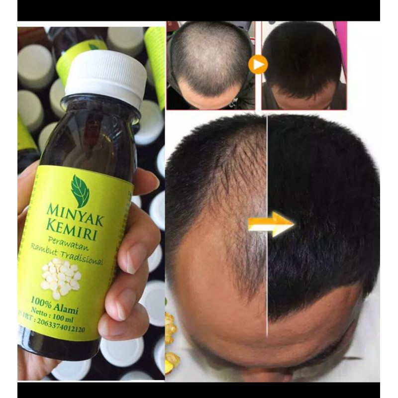 Original Candlenut Oil Hair Growth Hair Growth Vitamins Hair Loss Bald ...