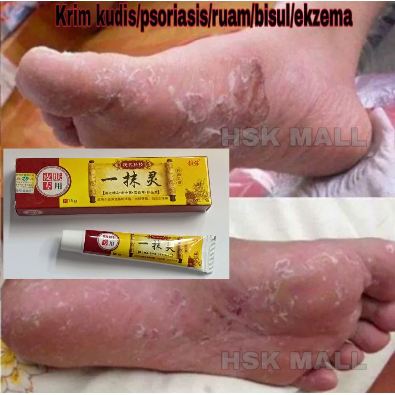 100%ORI Krim gatal kudis kurap 一抹灵 铍保牌子 15gram relief itching eczema ...