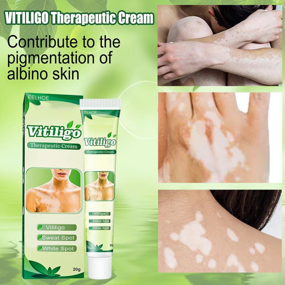 Sumifun 20g Vitiligo Cream Vitiligo Treatment Ointment Regulating ...