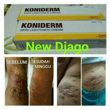 KONIDERM Ointment Relief Ore and Cesar Scar Original Ori Warranty ...