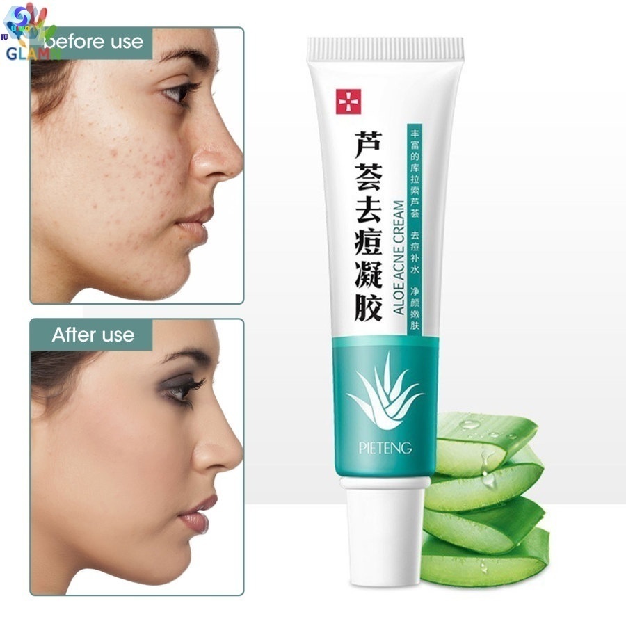 IU Aloe Vera Acne Cream, Lightening Dark Spots, Oil Control, Pore ...
