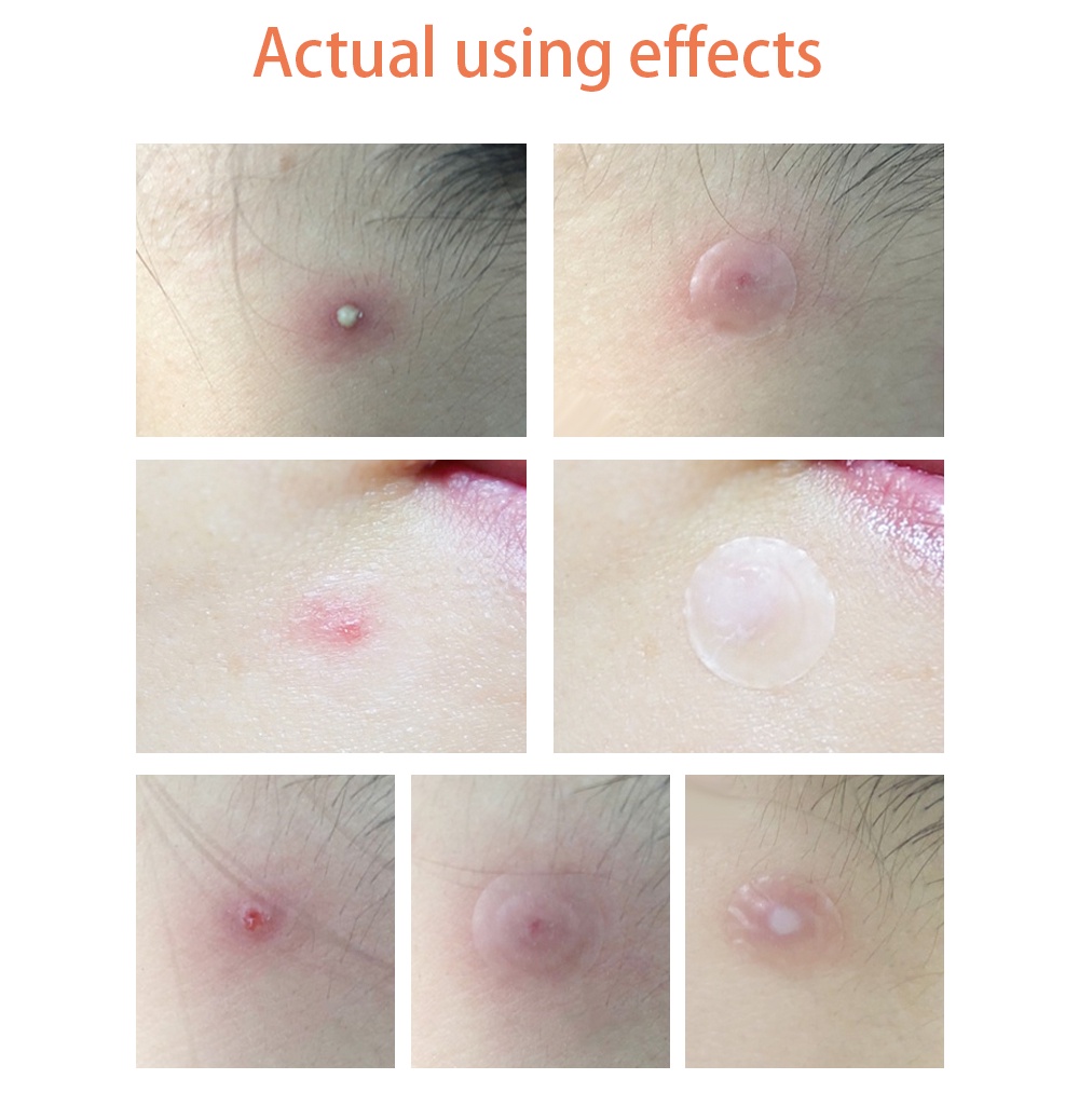 LANBENA Acne Pimple Patch/Daily & Night Pimple Patch/100% Original/Acne ...