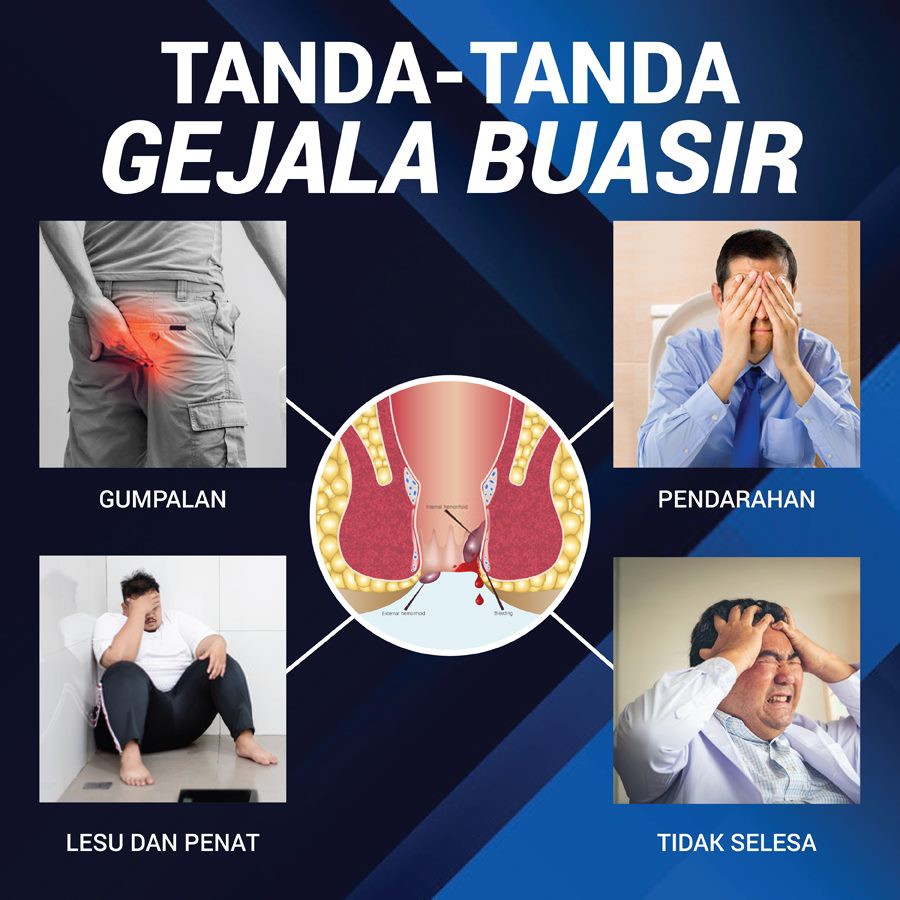 Ubat Buasir Sumbat Untuk Hilangkan Sakit Buasir | Shopee Malaysia