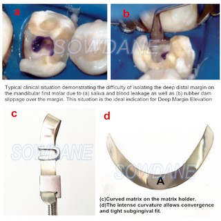Dental Tofflemire Matrix for Deep Margin Elevation Dental Large ...