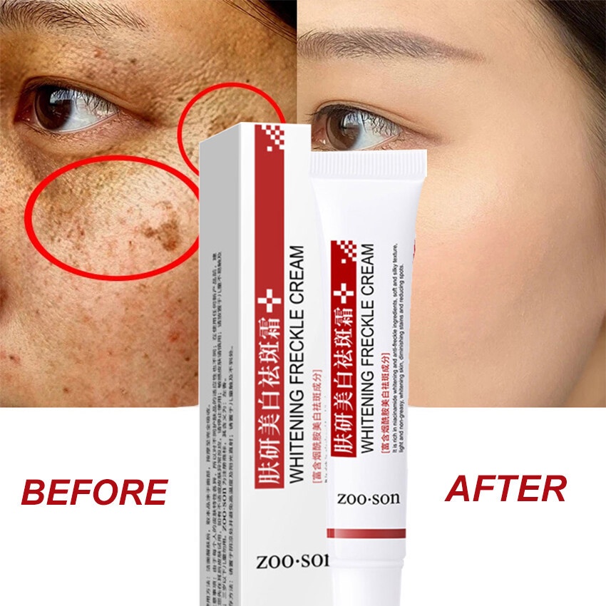 【TTLIFE】Dark Spot Corrector Cream Whitening Freckle Cream Powerful Removing Melasma Melanin Dark ...