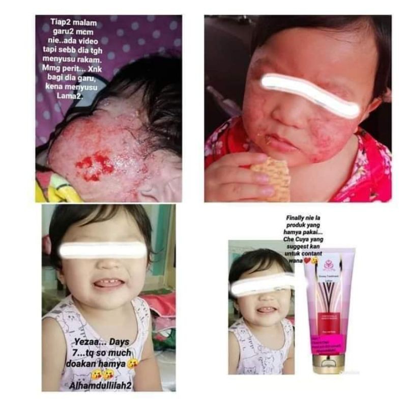losyen treatment exzema💥🔥 | Shopee Malaysia