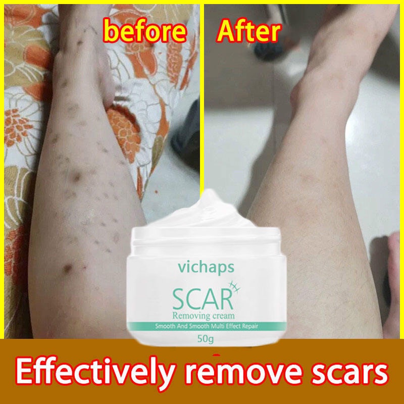 Recommended By Doctors Scar Treatment Cream 50G（ Scar Removal Gel,Acne ...