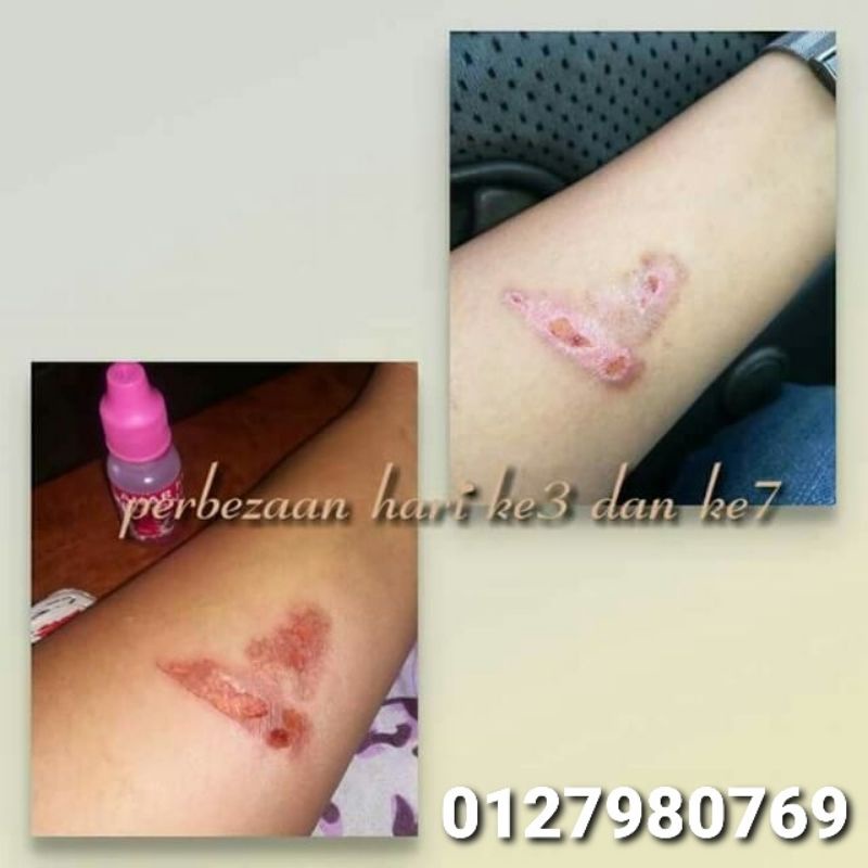 💢 PENYAKIT KULIT ECZEMA!! 🎁 + Air Ubat Penyakit Kulit Luka Gatal Ruam ...